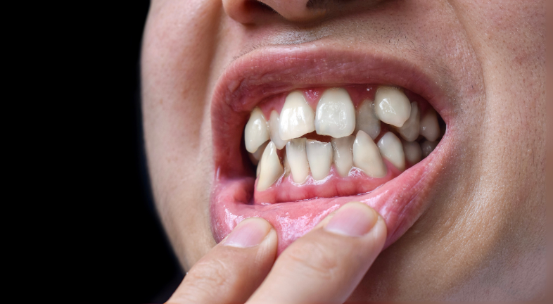 How to Fix Crooked Teeth Without Braces | Straight My Teeth